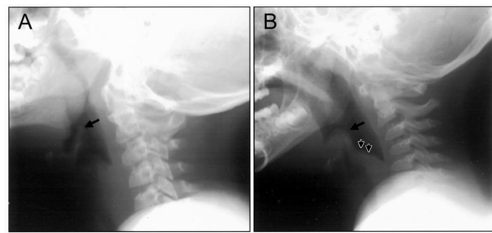 Panel a: normal lateral neck radiograph showing a thin