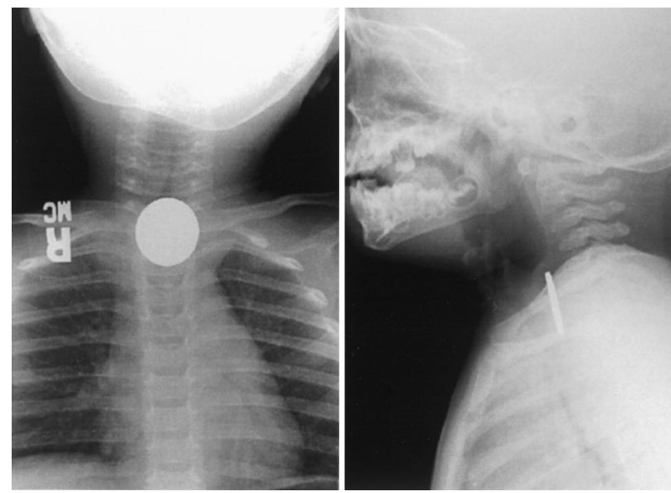 Frontal and lateral neck radiographs of a child who pre-