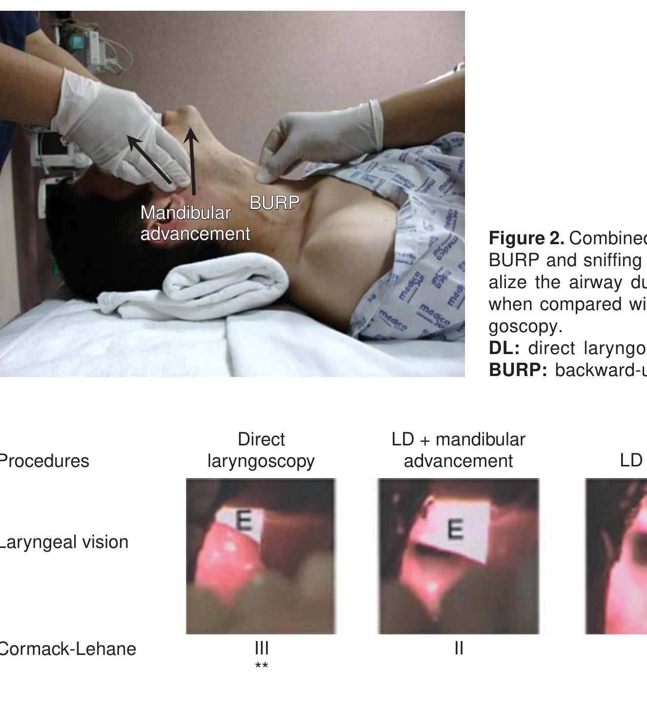 (PDF) The BURP maneuver