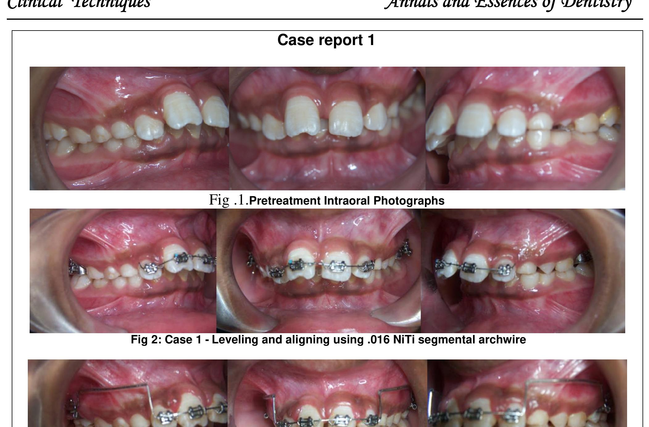 (PDF) Utility Arches in Orthodontics – Case Reports