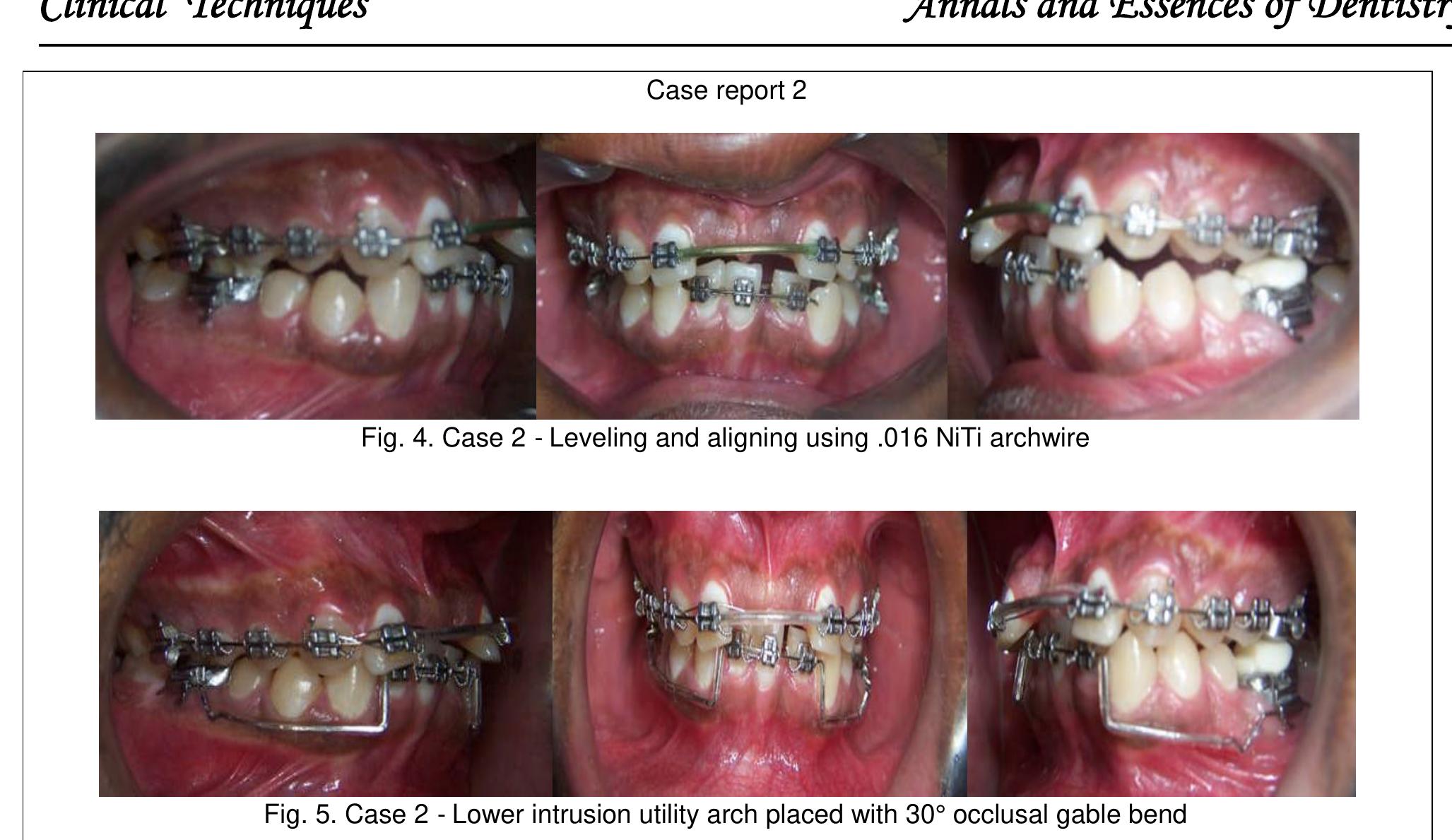 (PDF) Utility Arches in Orthodontics – Case Reports