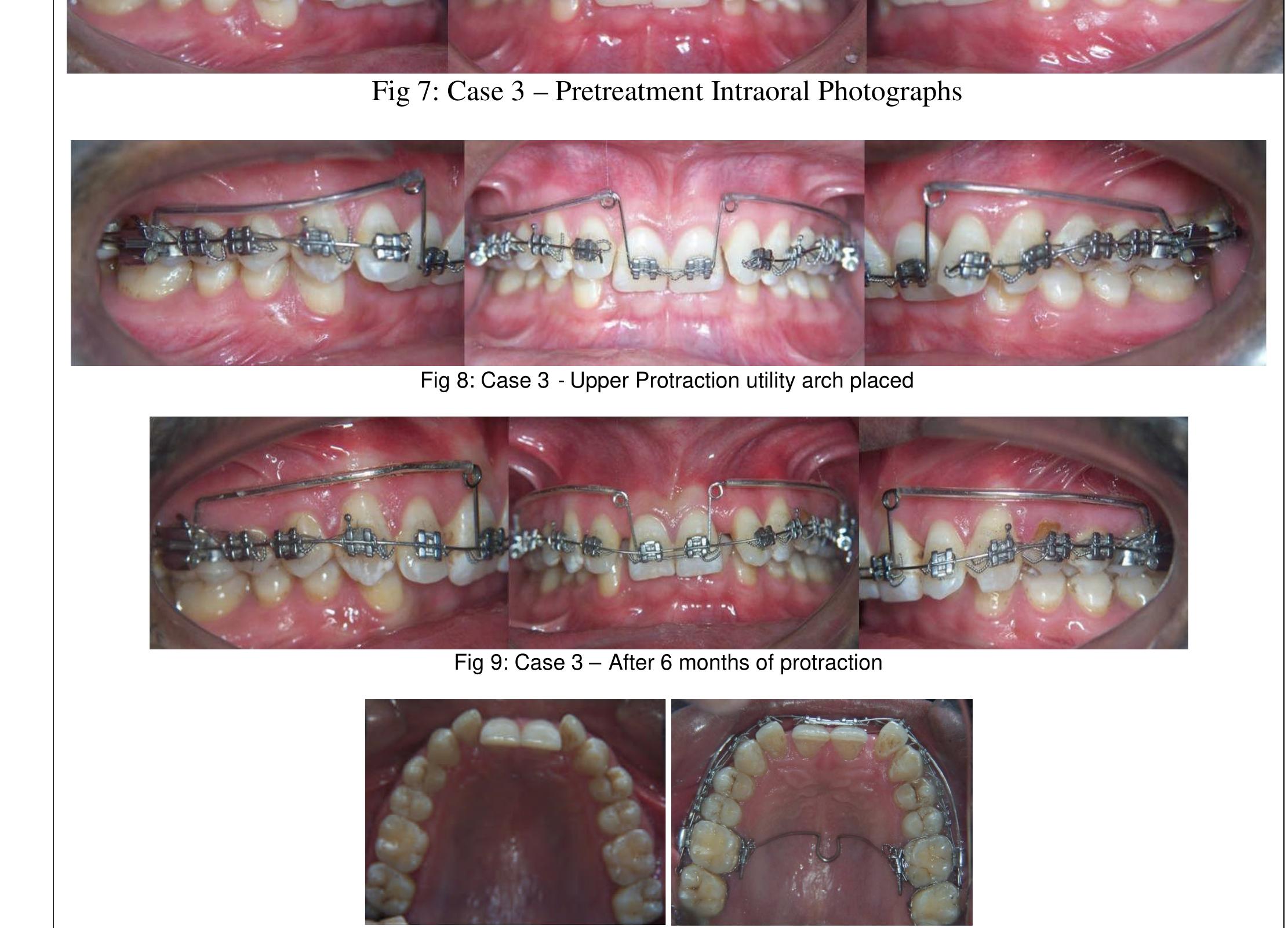 (PDF) Utility Arches in Orthodontics – Case Reports