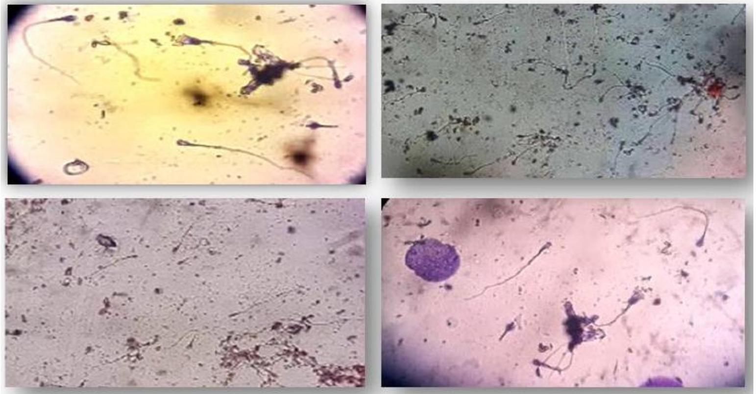 -6: spermatozoa on microscopic examination. gram positive