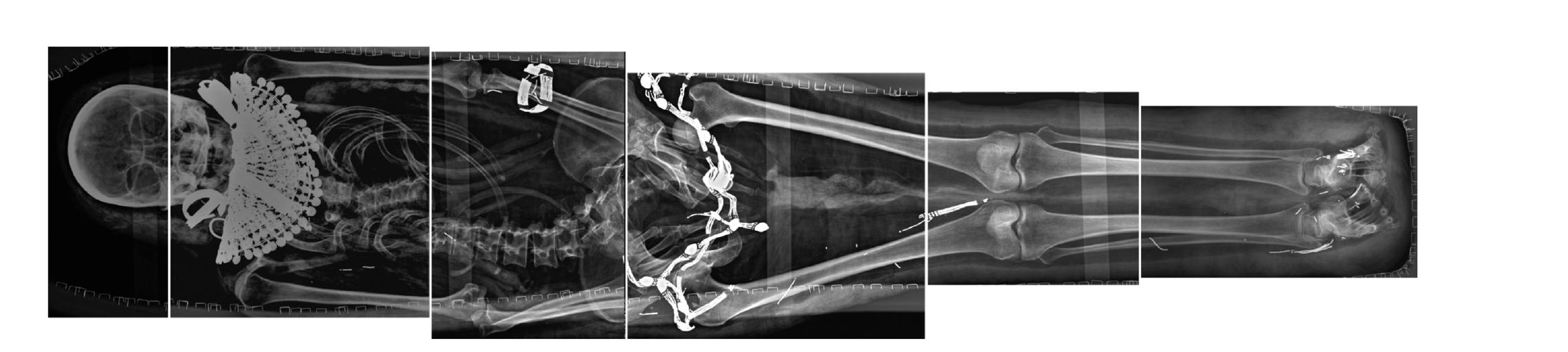 Merit’s total skeleton reconstruction.