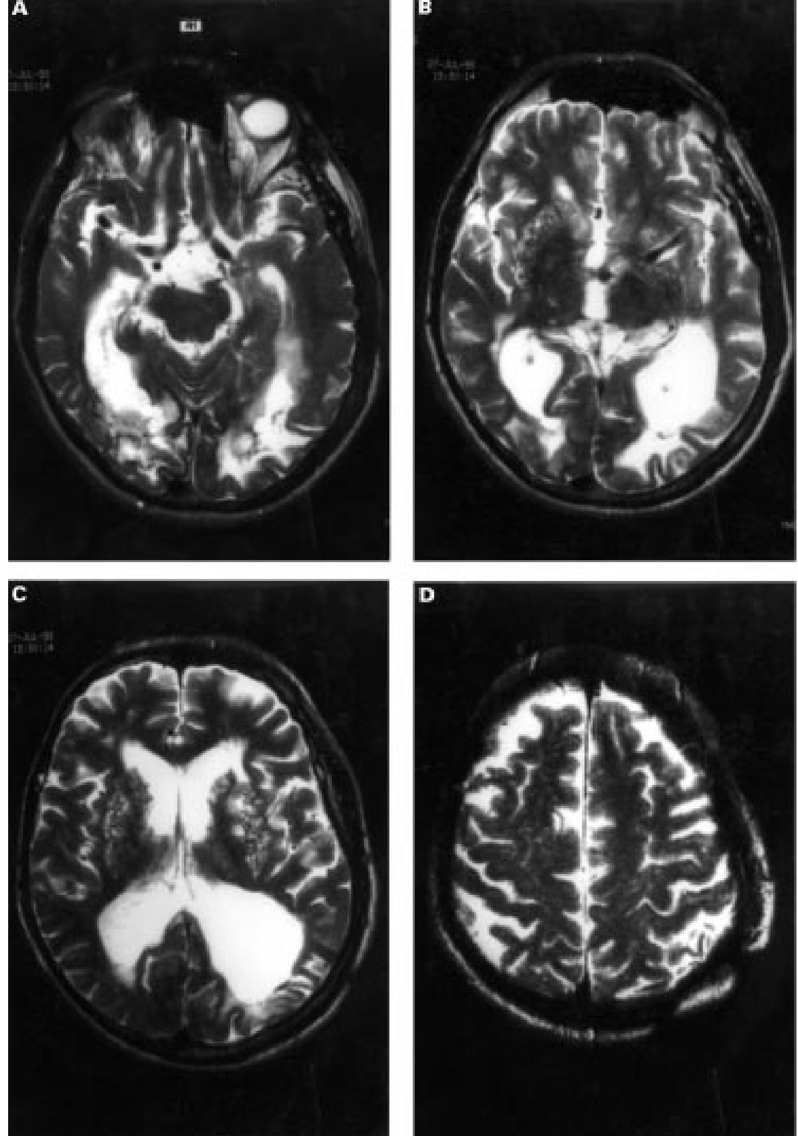 Representative horizontal mri cross section of the patient.