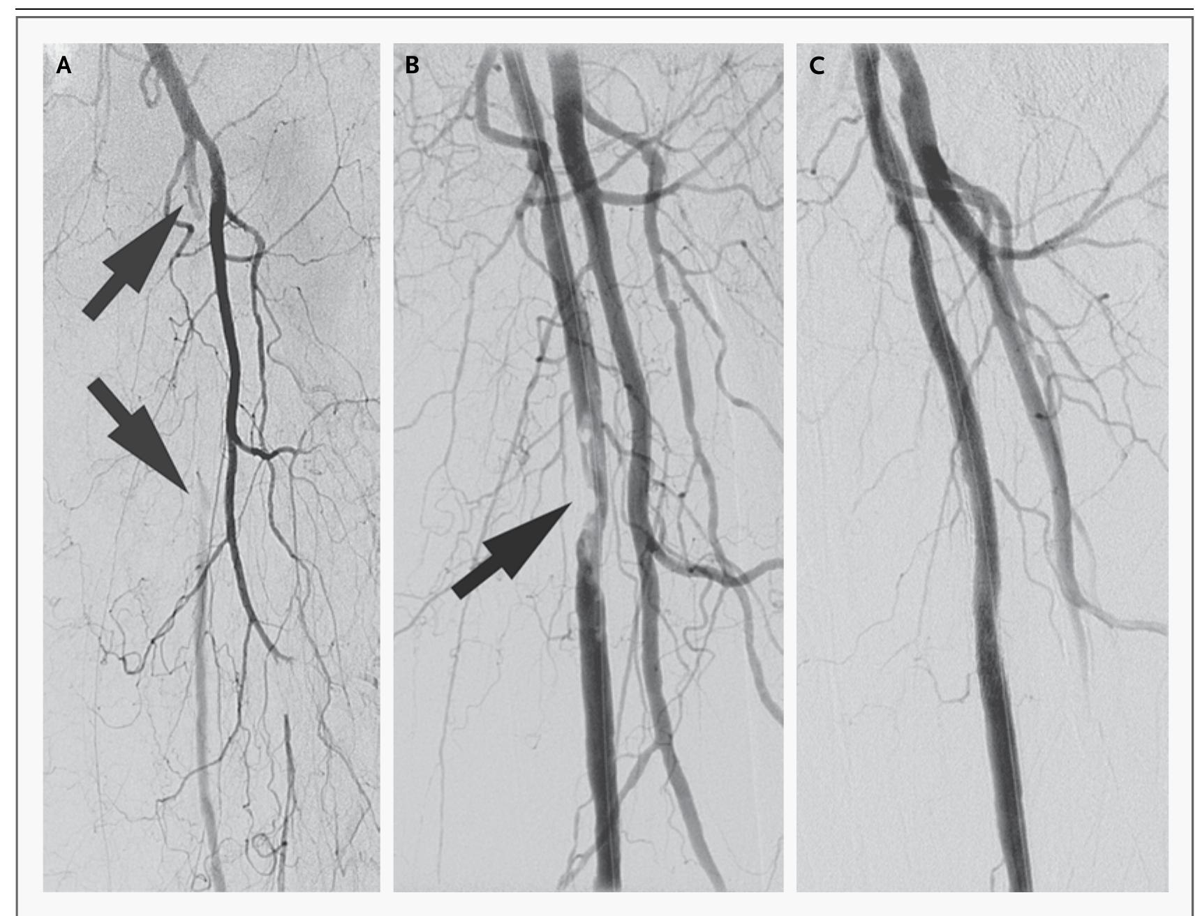 Acute ischemia of the left leg in a 68-year-old woman with