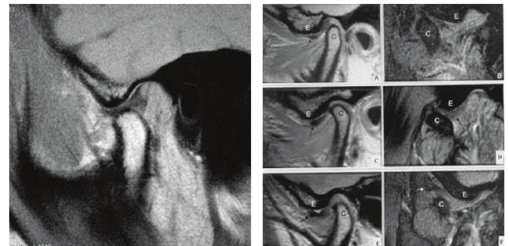 F igure-3: mri of tmj; figure-4: mri of tmj