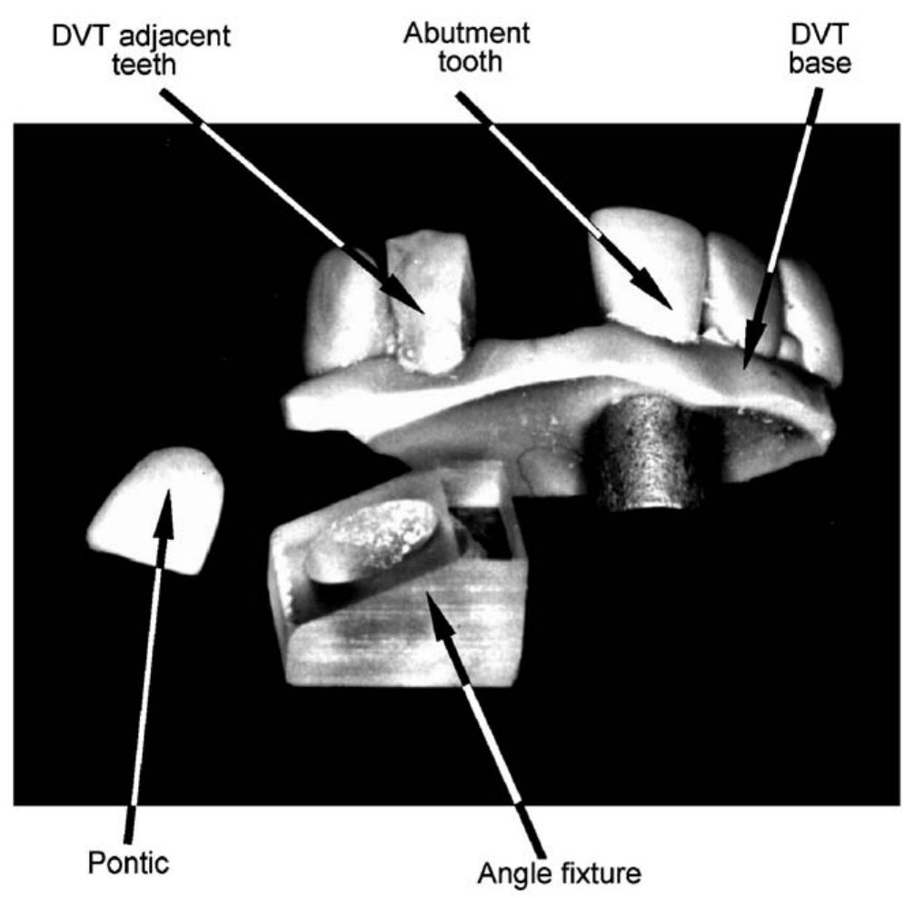 Resin pontic, abutment and adjacent teeth cast, and plastic