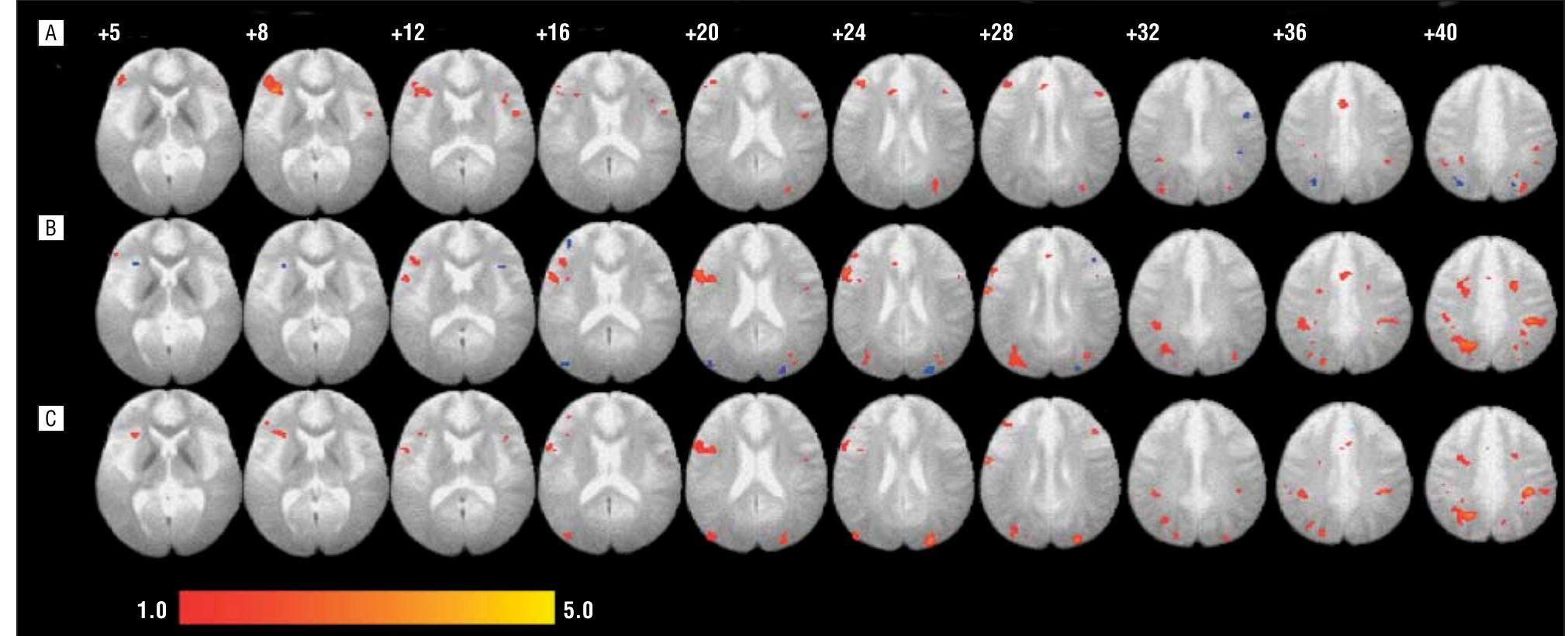 Statistical maps of analysis of variance results showing