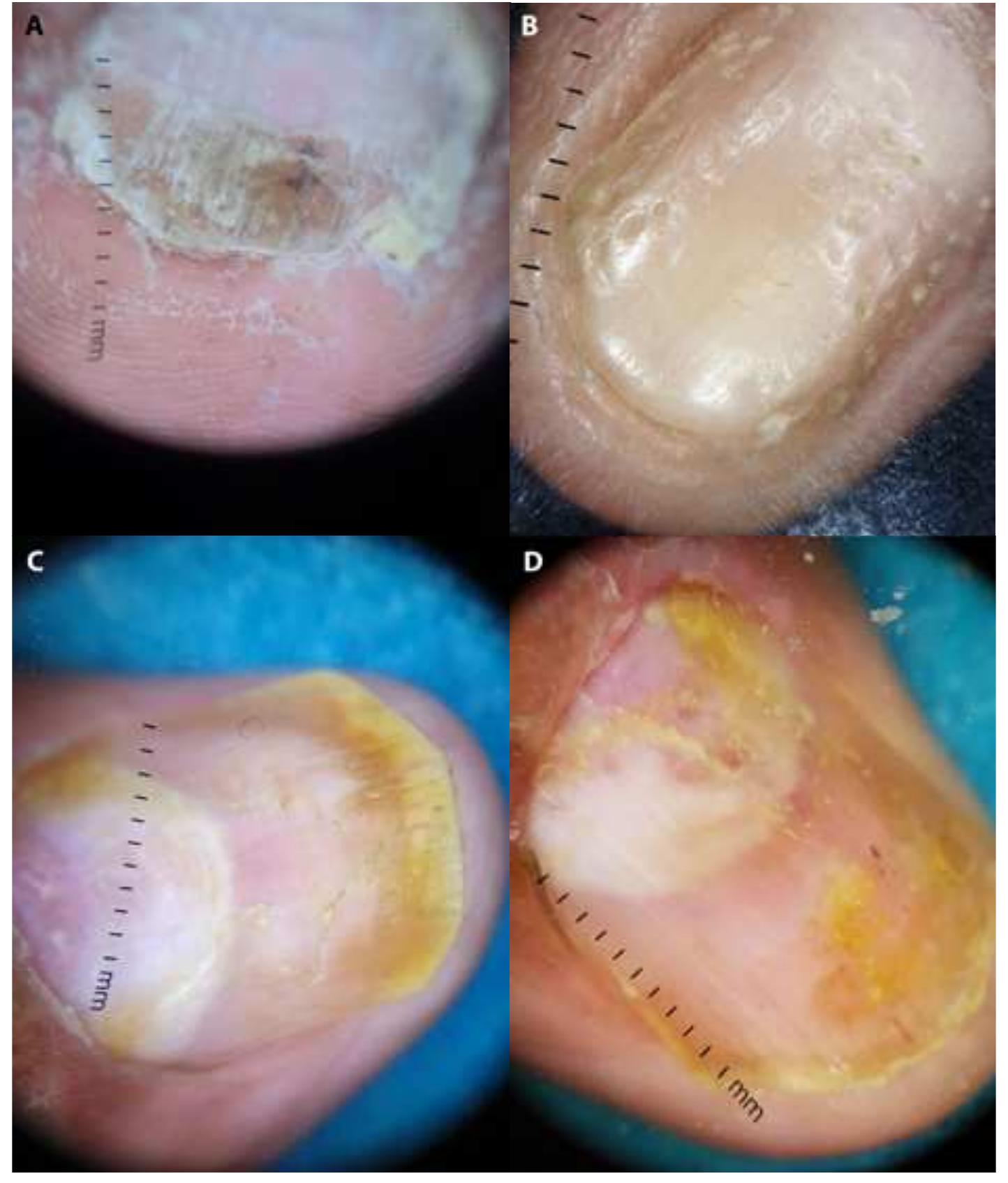 Dermoscopic image. (a) subungual hyperkeratosis. (b)
