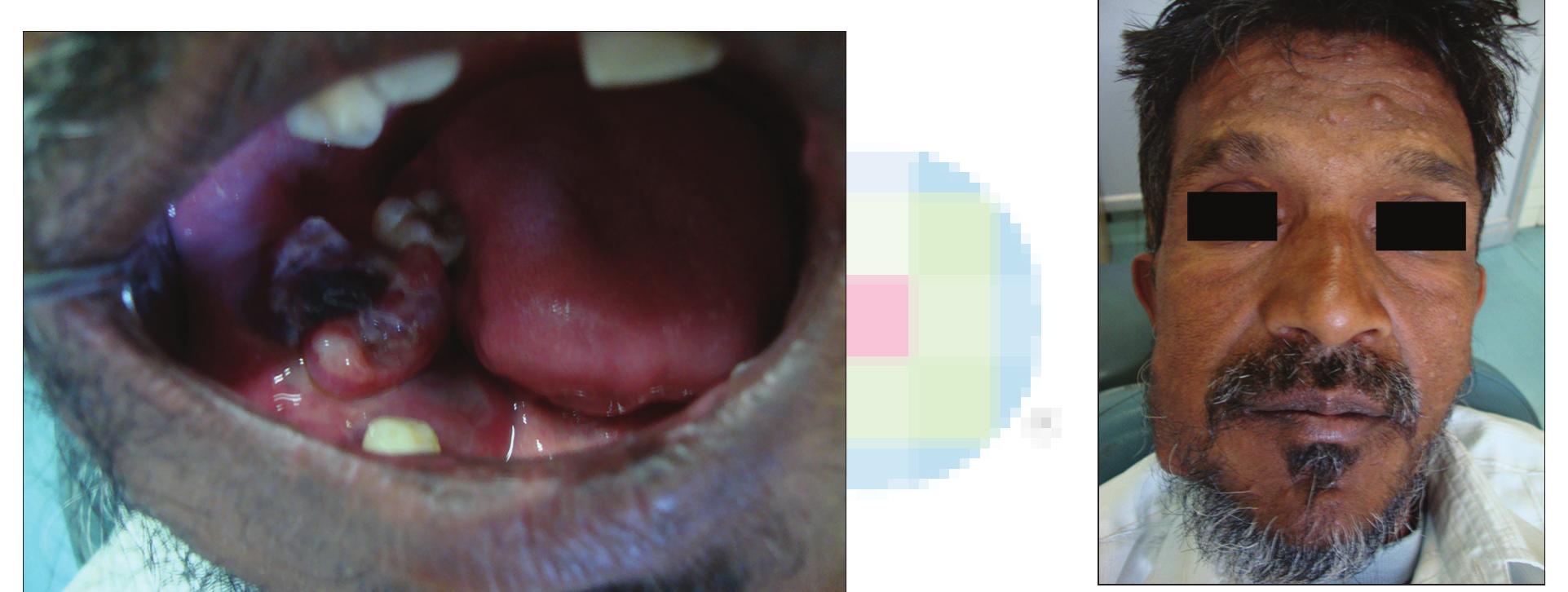 Extra-oral swelling present on the right side of face along