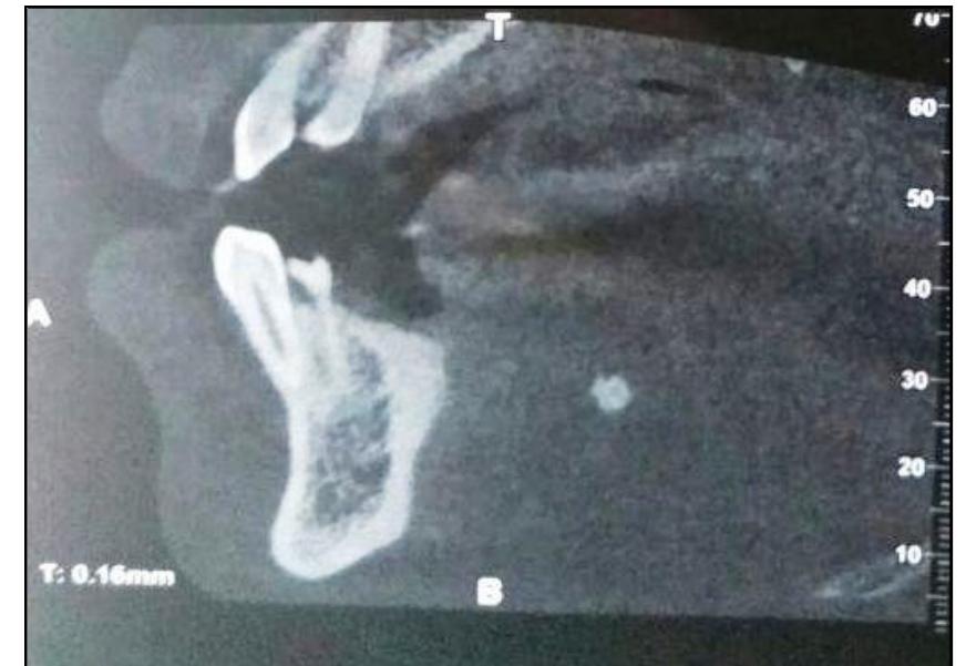 Discussion fig. 2: sagittal view of cbct depicting small