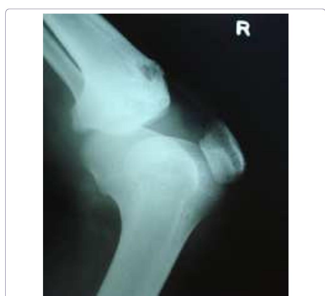 Radiograph of tuberculosis tenosynovitis and arthritis at