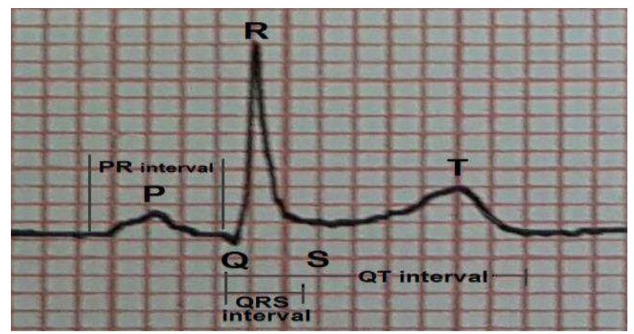 Main components in ecg signal (see online version for