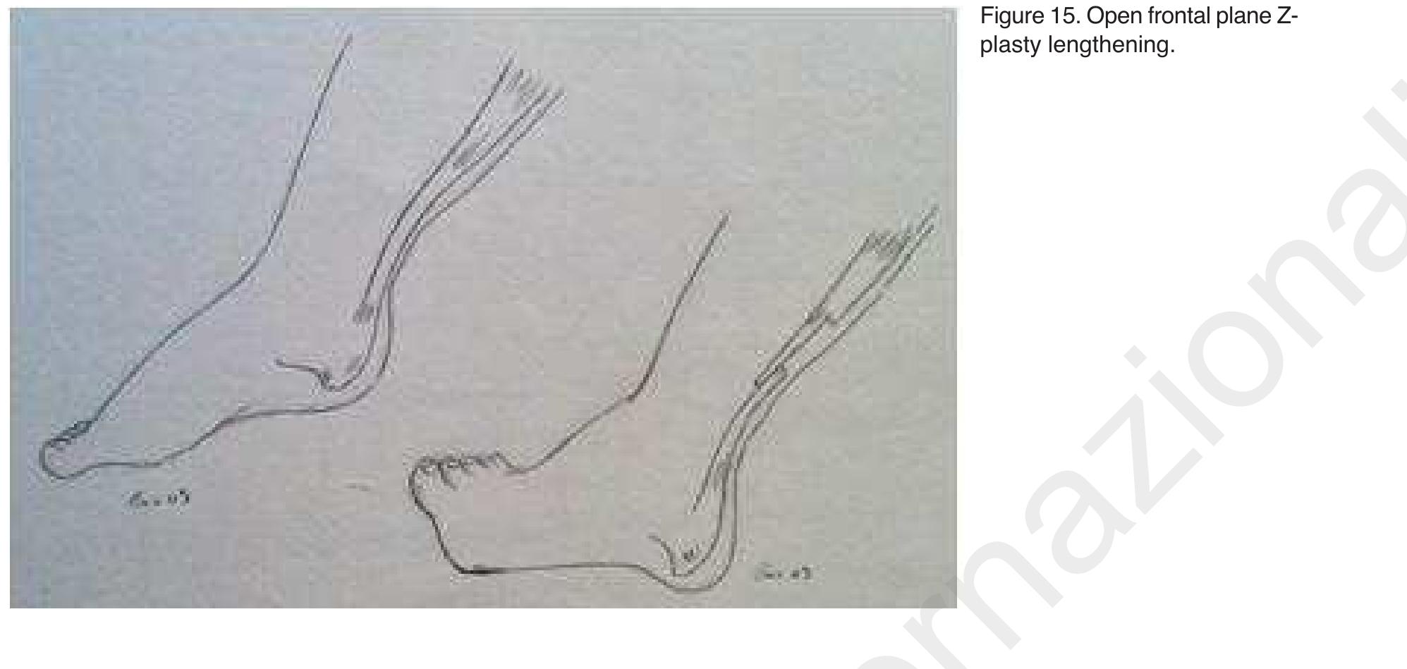 Figure 15 - Musculotendinous equinus deformity correction: