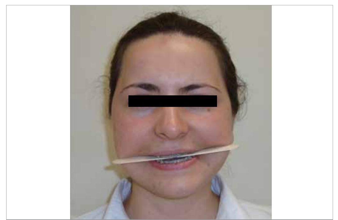 Pretreatment extraoral photograph showing the occlusal cant