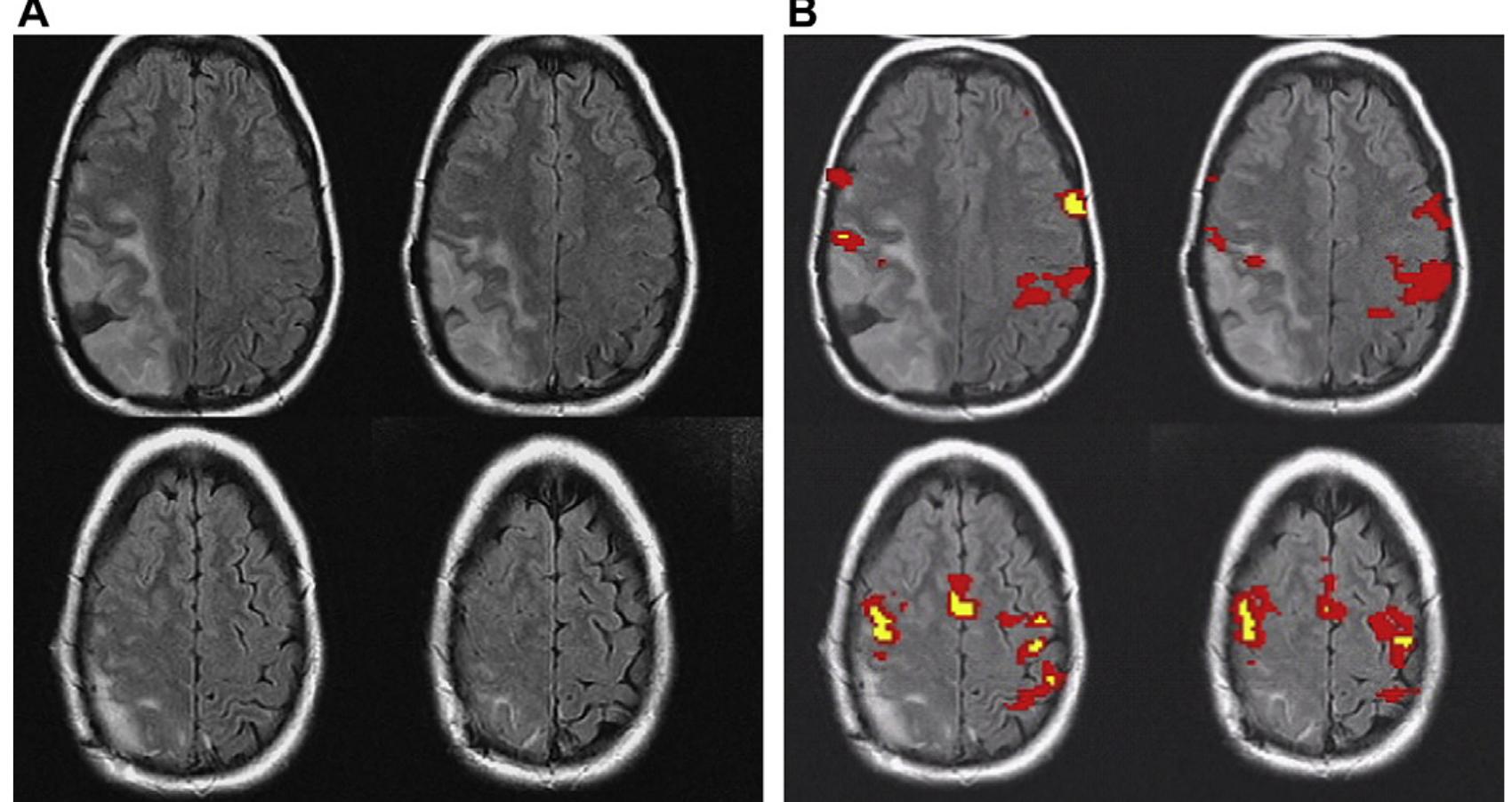 Fmri motor map of a 38-year-old woman with a low-grade
