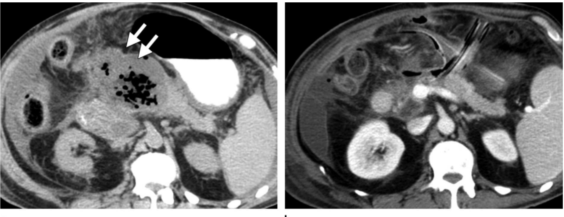 Subacute pancreatitis with infected necrosis. (a)