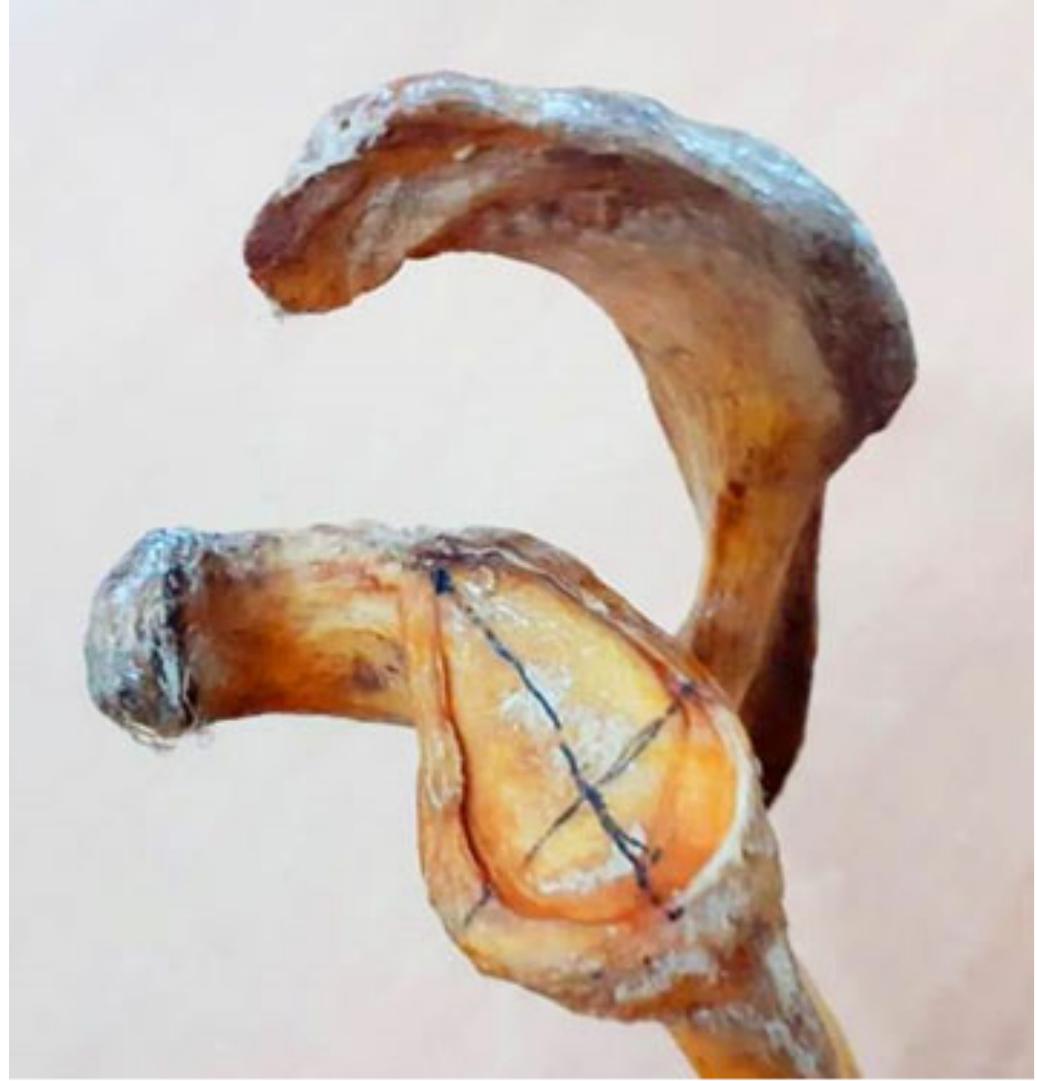 Hooked acromion process.