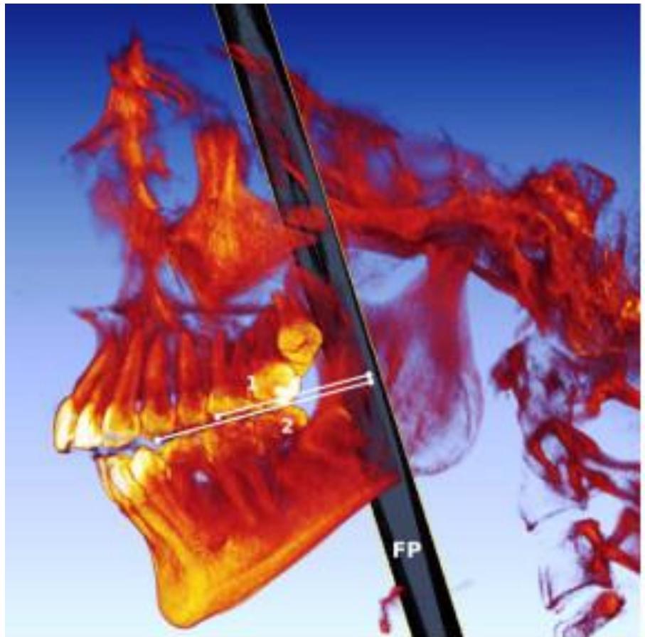Cbct volumetric image showing 1 the maxillary canine