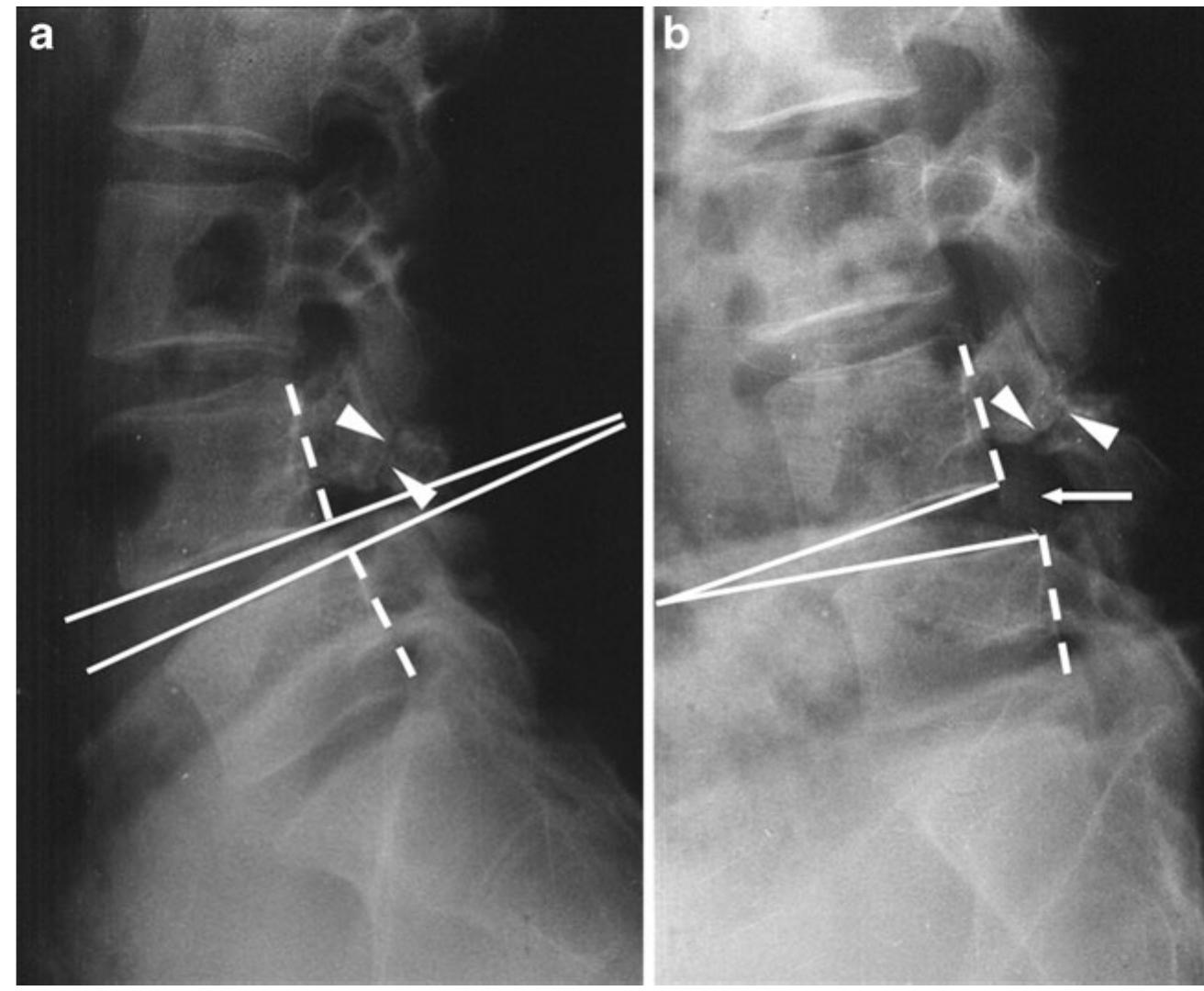 Functional lateral radiographs of lumbar spine in a 19-year-
