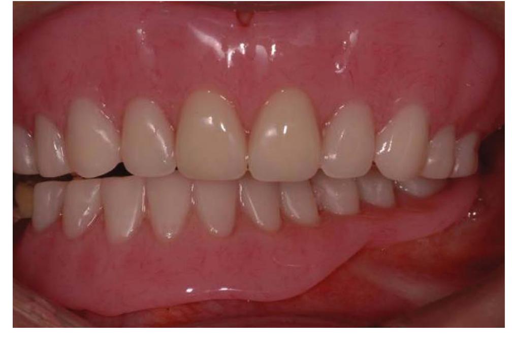 Frontal view of the maxillary and mandibular dentures in a