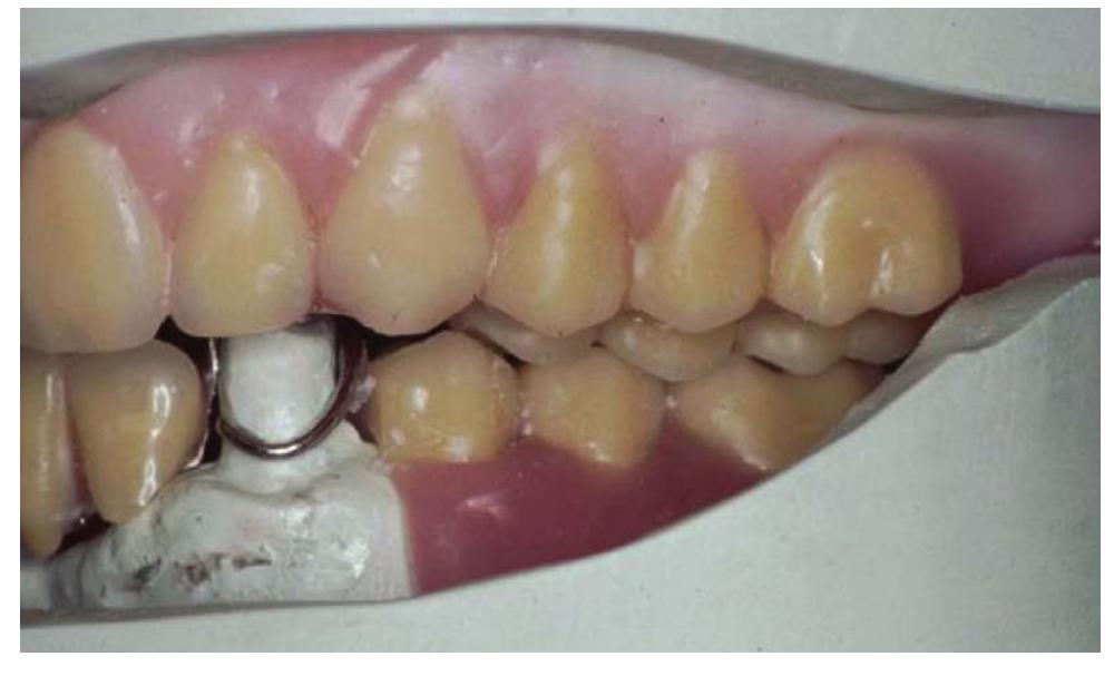 Medial deviation of a mandibular discontinuity defect