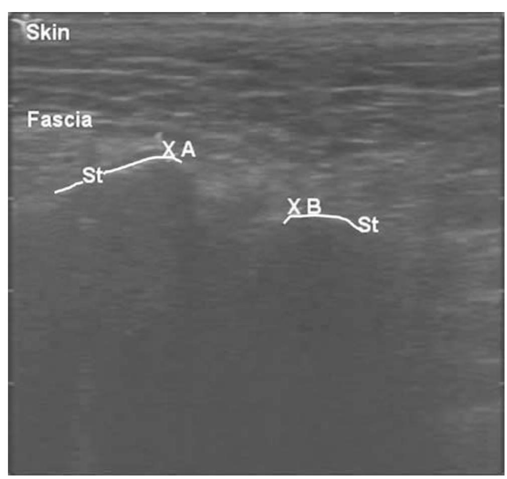 Ultrasound image showing an anteroposterior view of the