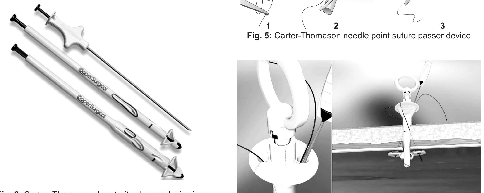 Weck efx™ endo fascial closure system (efx) kotakala and