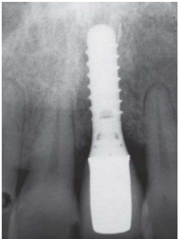 Figure 14 Extraction Defect Assessment Classification