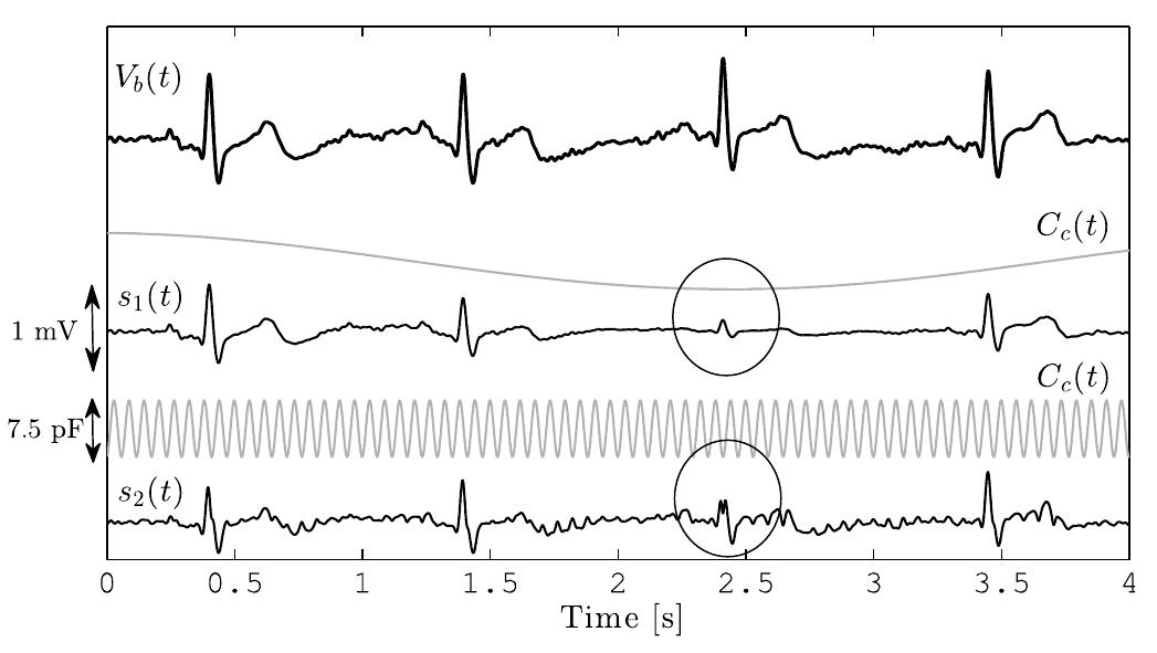 Two examples of ecg distortions. when the coupling