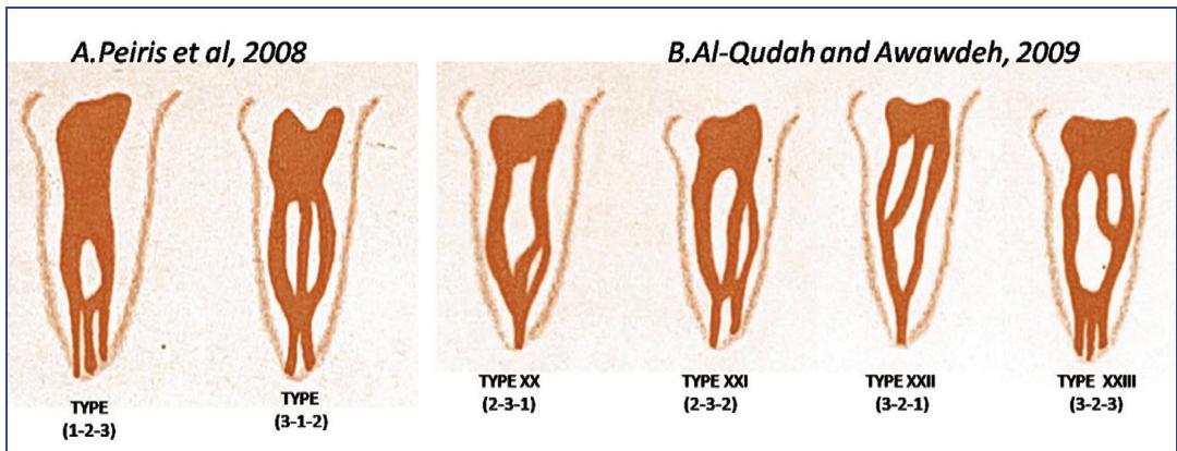 [table/fig-4]: the root canal configurations from the pulp