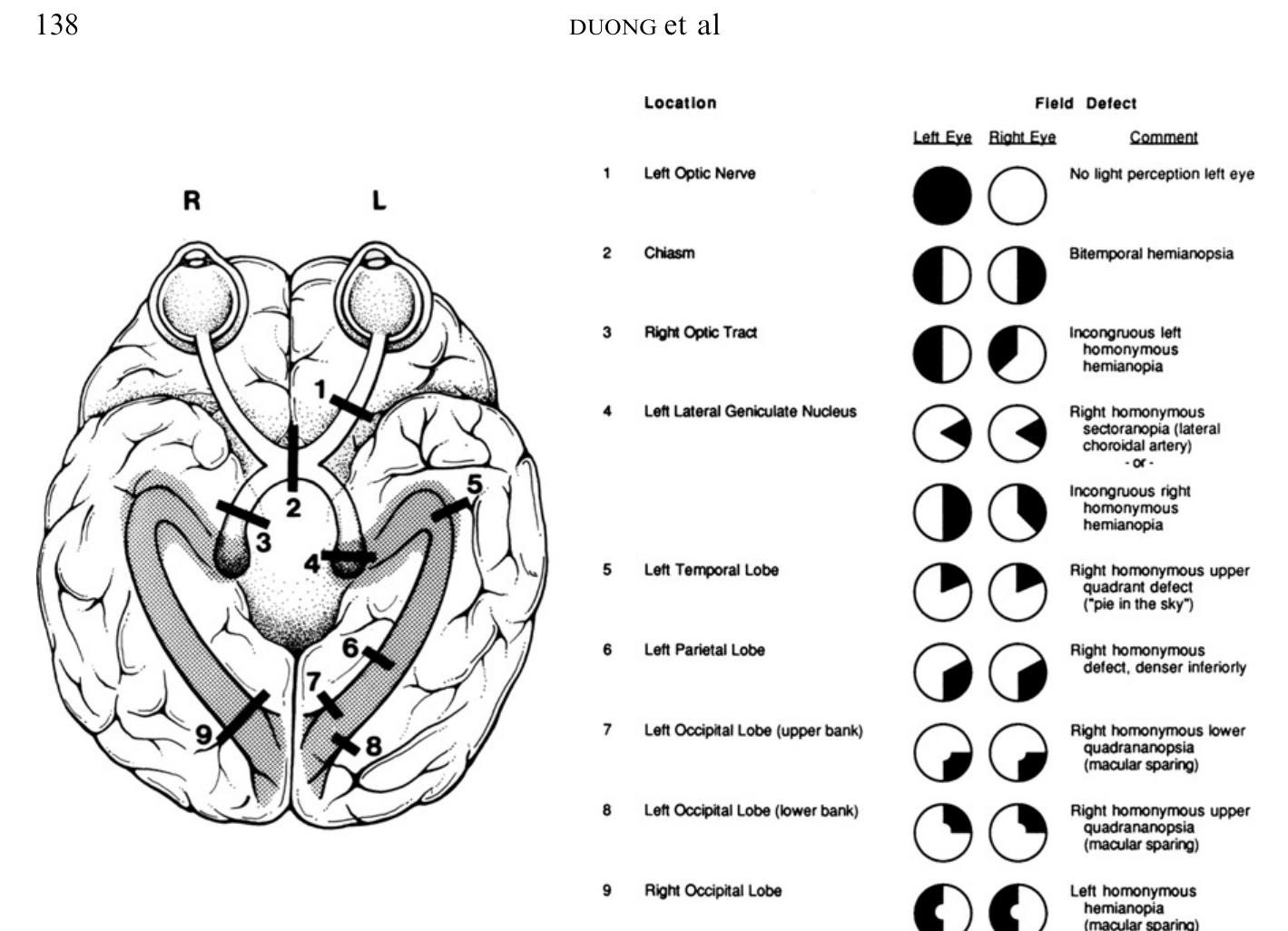 “ig. 1. lesions of the afferent visual pathway and their