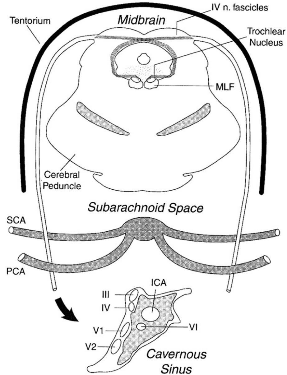Anatomy of the trochlear nerve. the speckled area demarcates