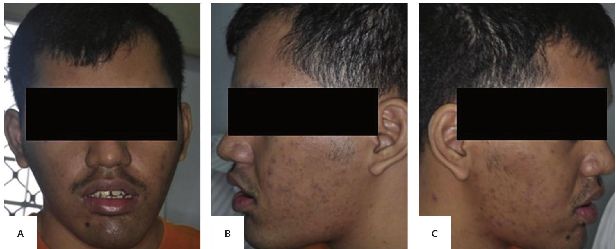 Extraoral profile of the 22-year-old male patient shows