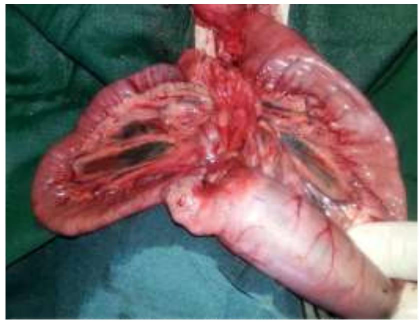 Figure 4 - Double Intestinal Intussusception due to Acute