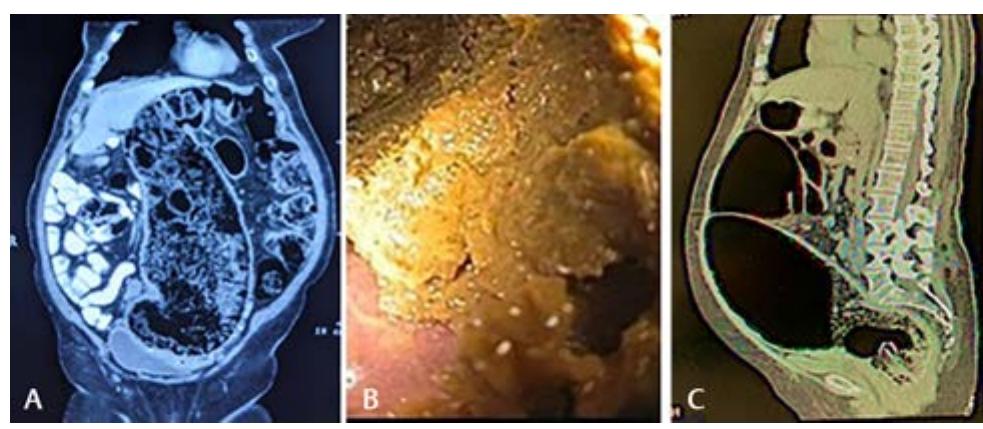 (a) coronal view of computed tomography (ct) scan of abdo-