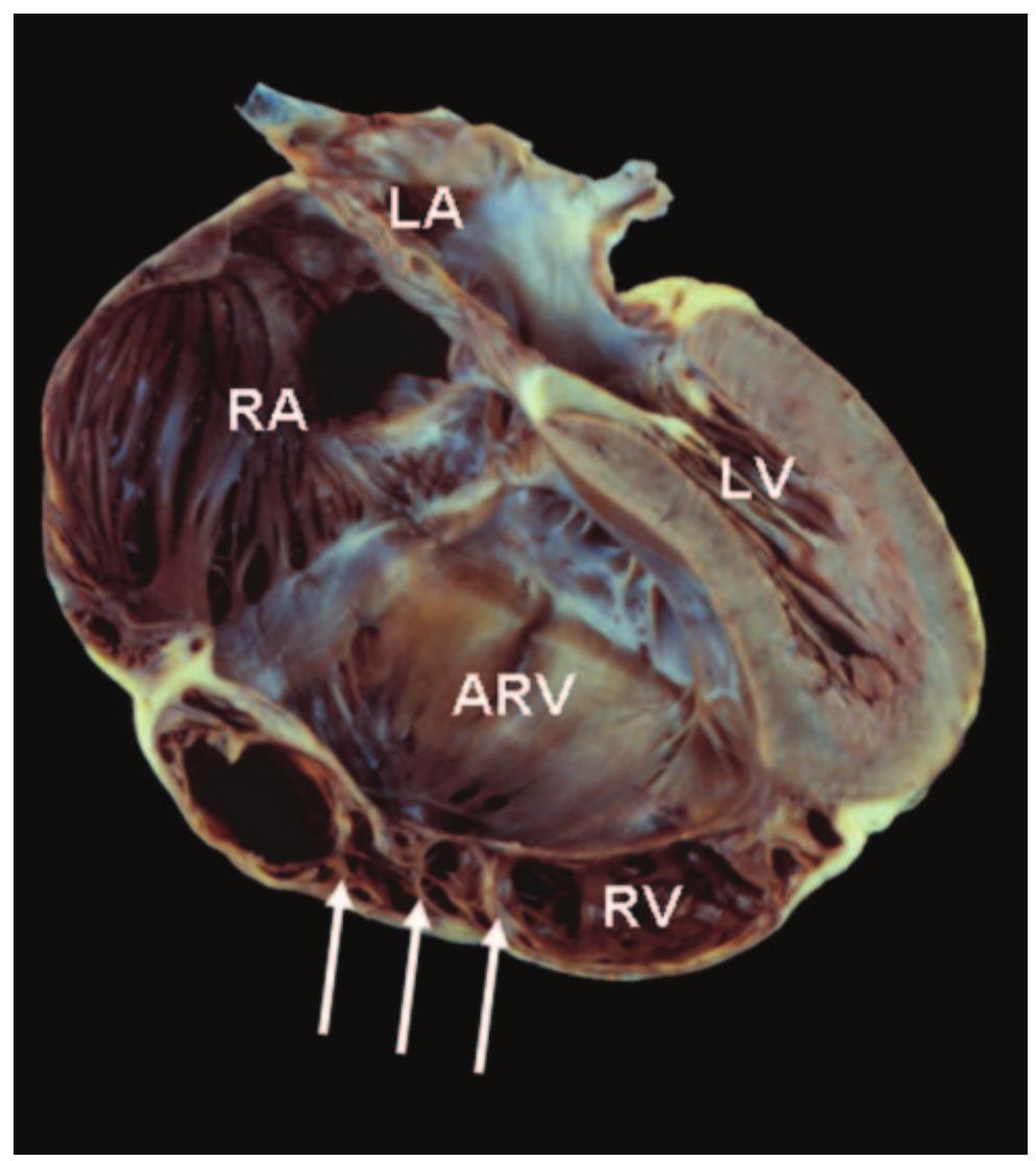 Severe ebstein’s malformation of tricuspid valve (4-chamber