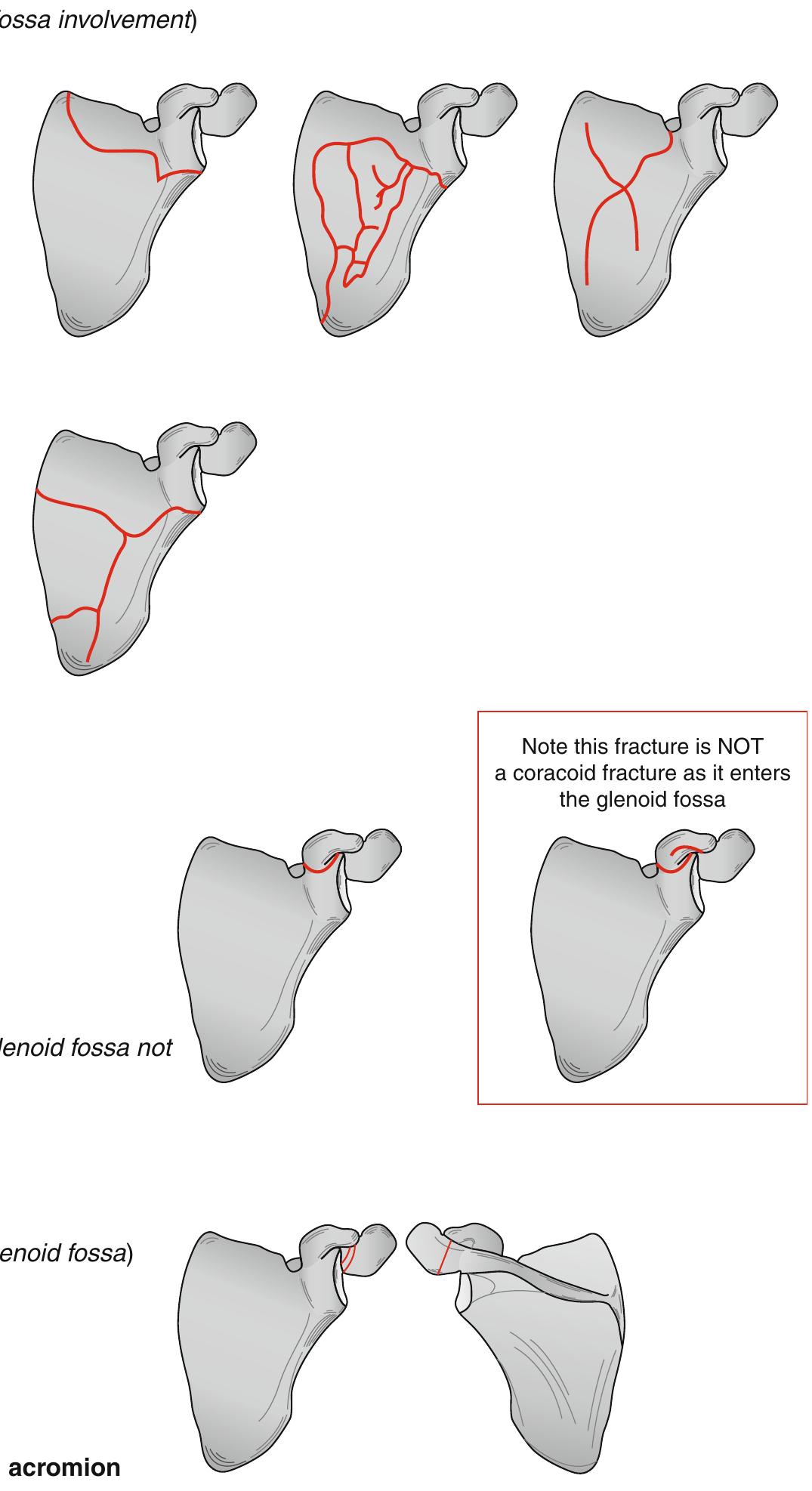 Figure 3 - Fractures of the Scapula