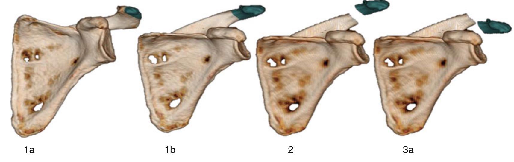 Classification scheme of acromion fractures according to