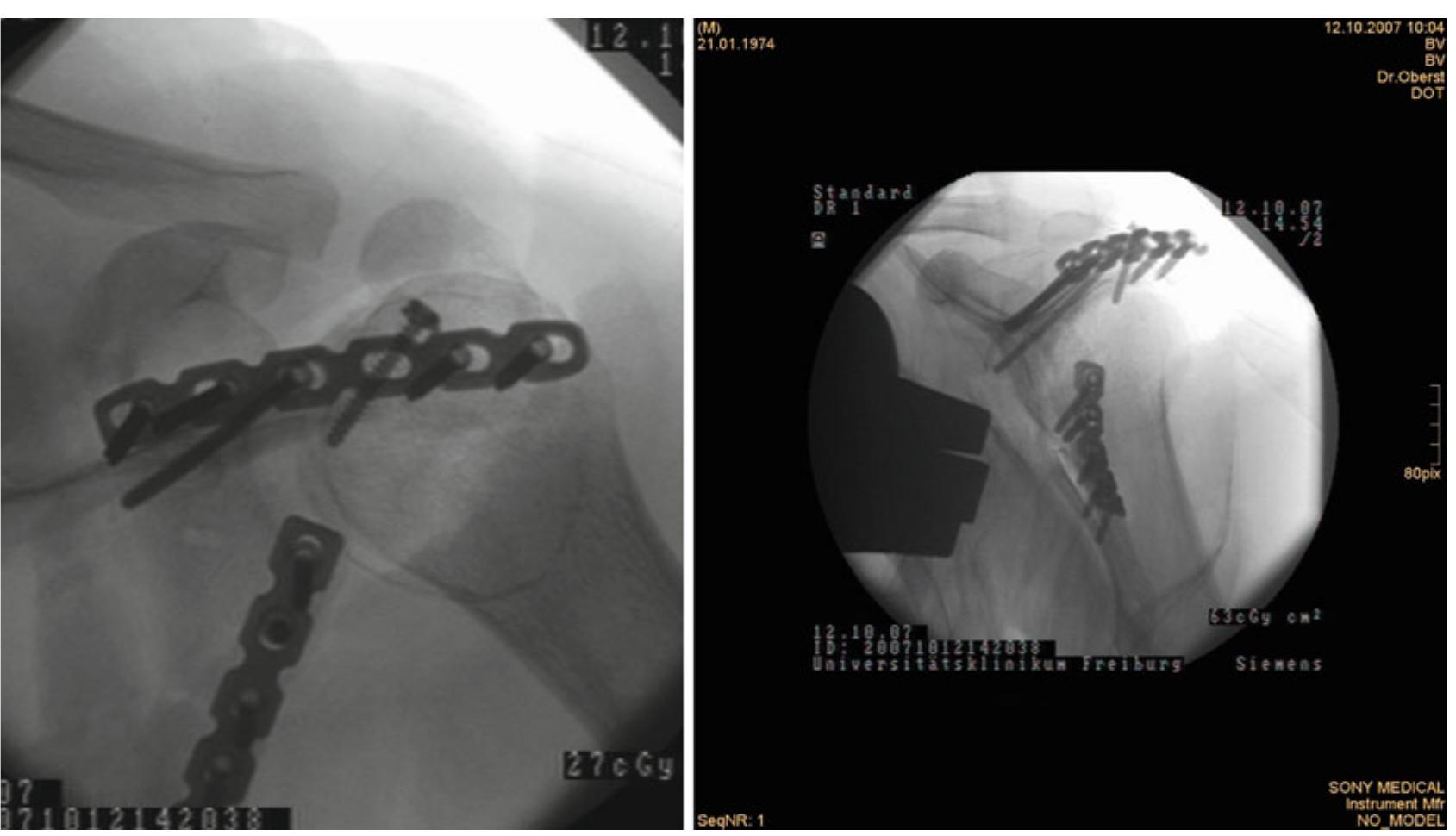 Open reduction and internal fixation of a scapular body