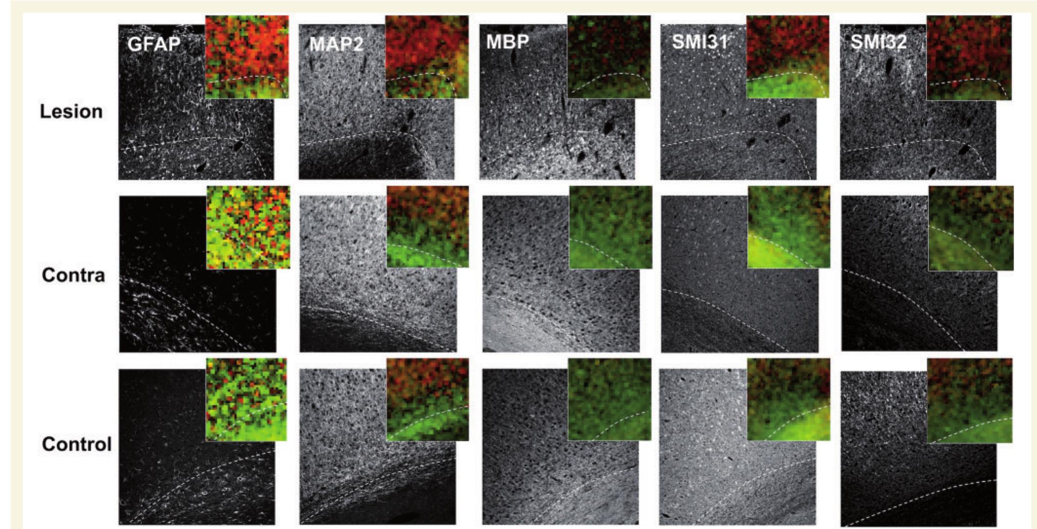 Cellular components of controlled cortical impact lesions