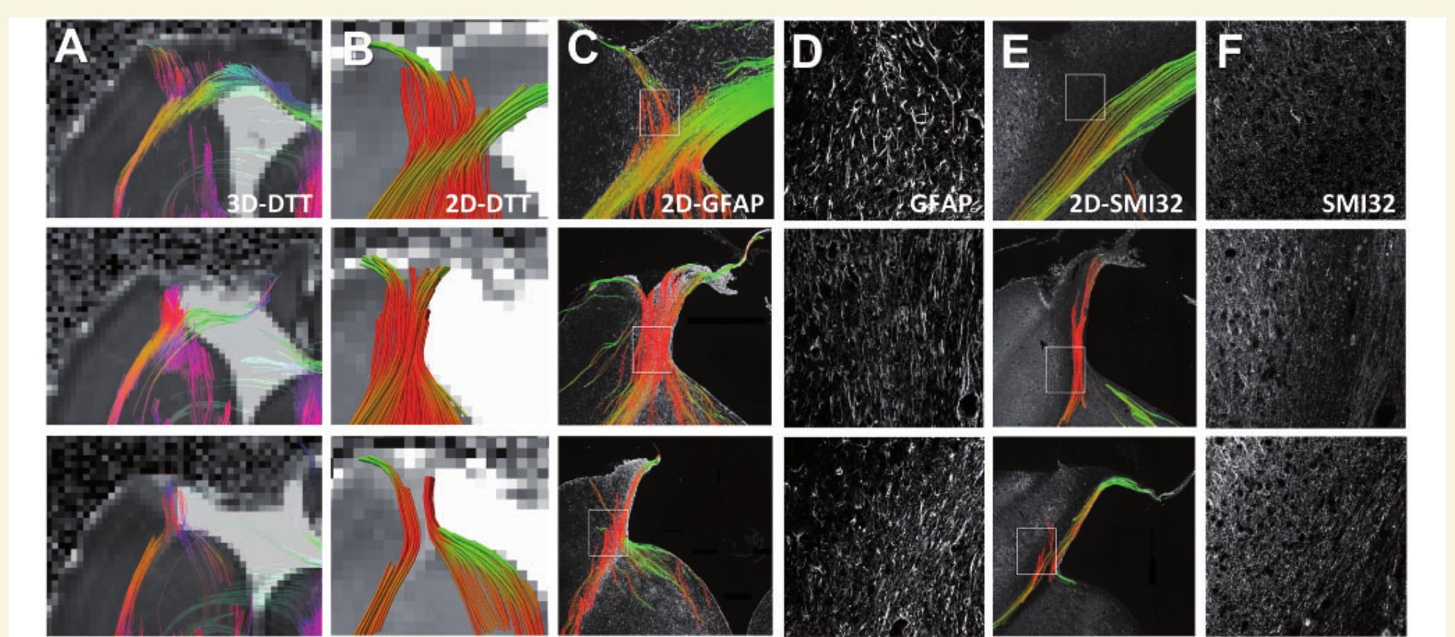 Comparison of diffusion tensor tractography and