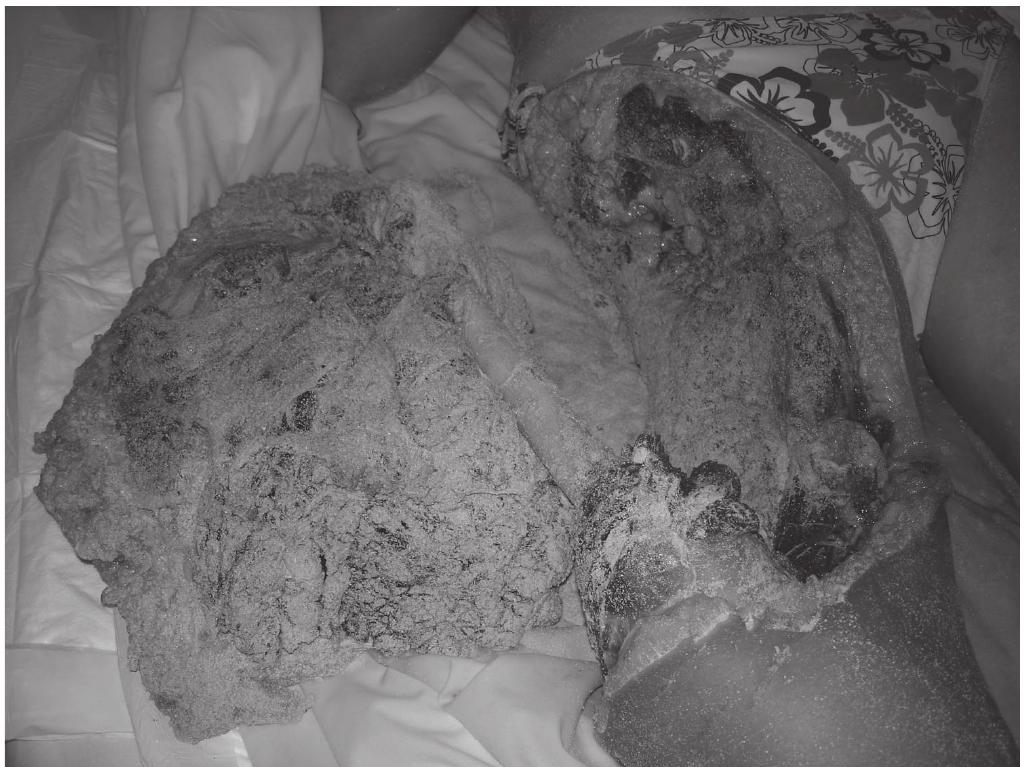 The shark bite on the right thigh of the victim. the bite is