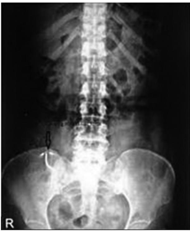 X-ray report showing copper t in right iliac fossa on