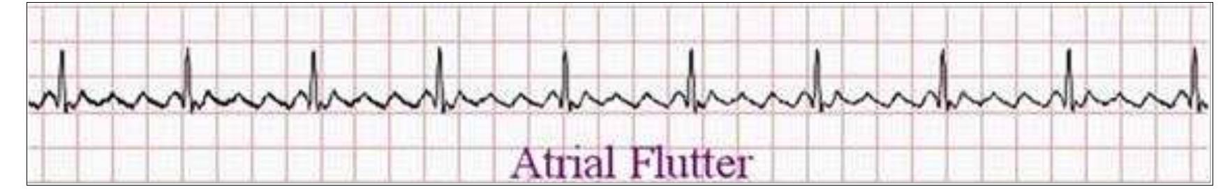 Atrial flutter is a form of supraventricular tachycardia
