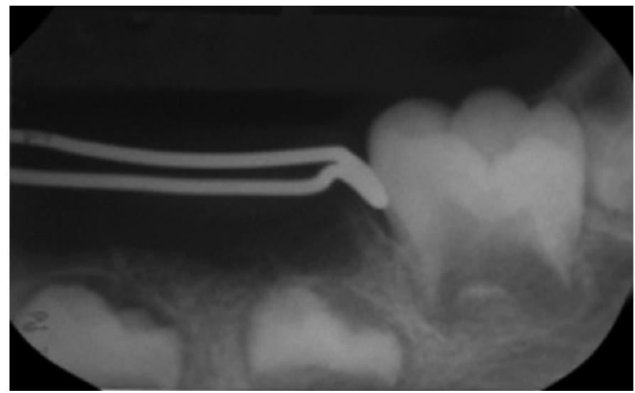 Intraoral periapical radiograph showing the modified