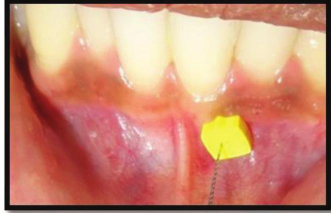 Transgingival probing.