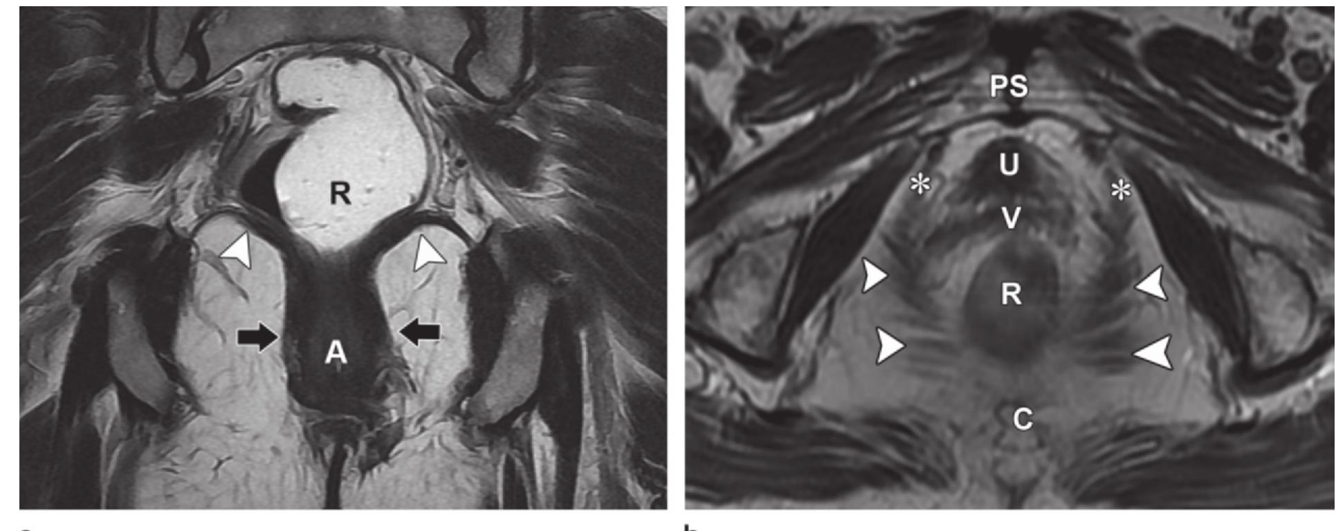 Normal female pelvic floor anatomy. coronal (a) and axial