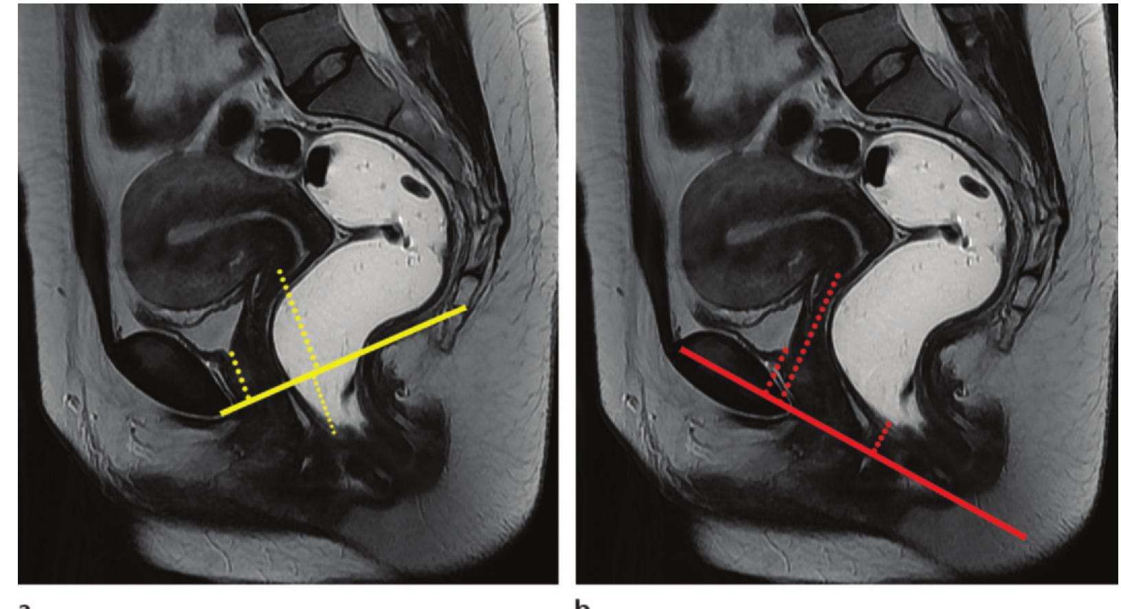 Midsagittal t2-weighted mr images obtained in a female